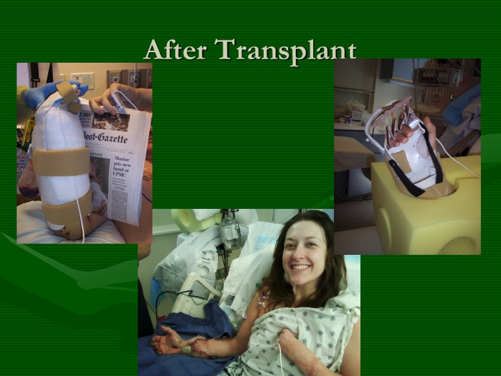 Keys to Occupational Therapy with Hand Transplants - Article 2385